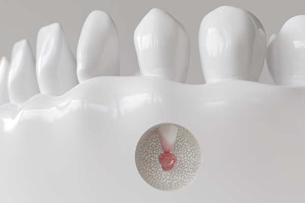 Root tip inflammation with apicectomy – 3D rendering | 新座市・志木駅近くでの口腔外科 ...